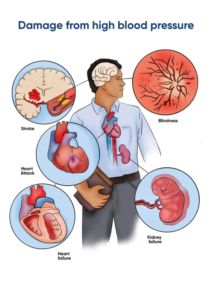 High blood pressure (HBP) / Hypertension (HT) - Public Web SLCIM